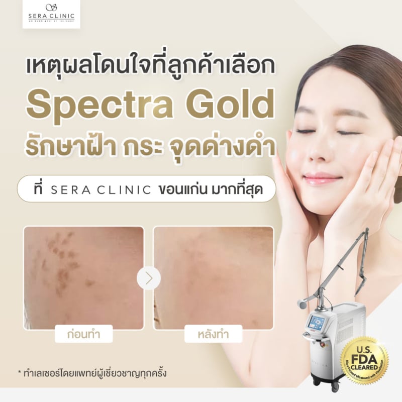 เหตุผลที่ลูกค้าเลือก Spectra Gold รักษาฝ้า กระ จุดด่างดำ ที่ Sera ...