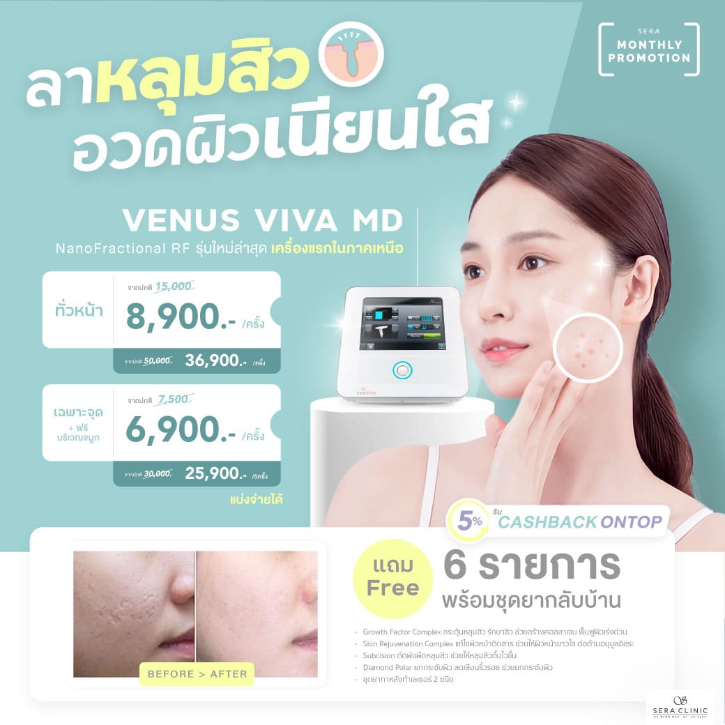 โปรโมชั่น Venus Viva MD รักษาหลุมสิว - Sera Clinic by Dr.Hanui