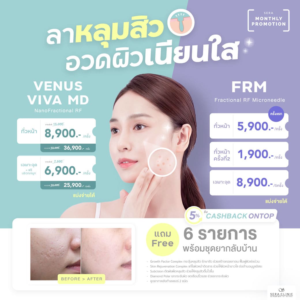 โปรโมชั่น Venus Viva MD & FRM รักษาหลุมสิว - Sera Clinic by Dr.Hanui