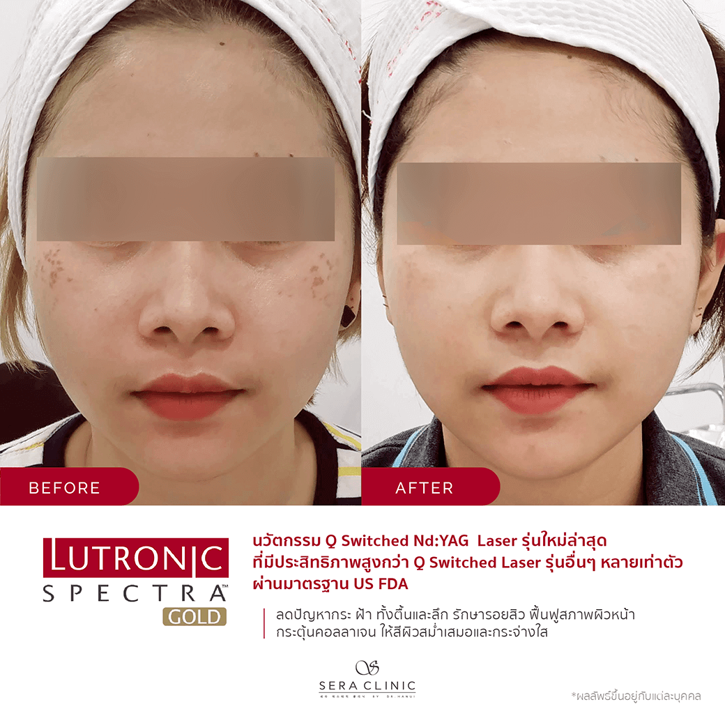 ผิวใส ไร้รอยดำ ด้วย Spectra Gold รักษาฝ้า กระ จุดด่างดำ - Sera Clinic
