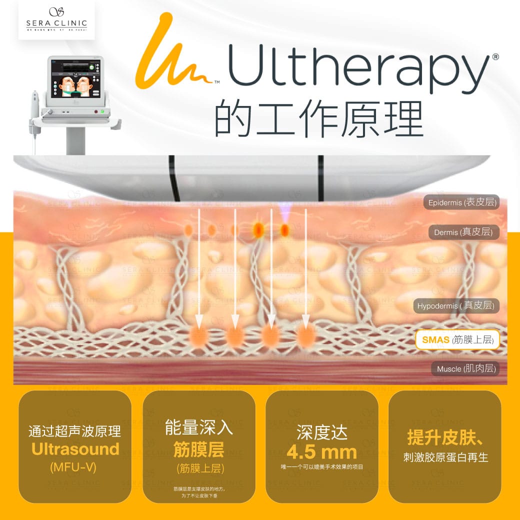 Ultherapy SPT 提升脸部最好的仪器 大脸变小脸 减少皱纹 效果堪比手术
