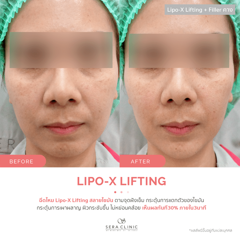 LIPO-X Lifting เหนือกว่าเมโสแฟตที่เคยลอง - Sera Clinic