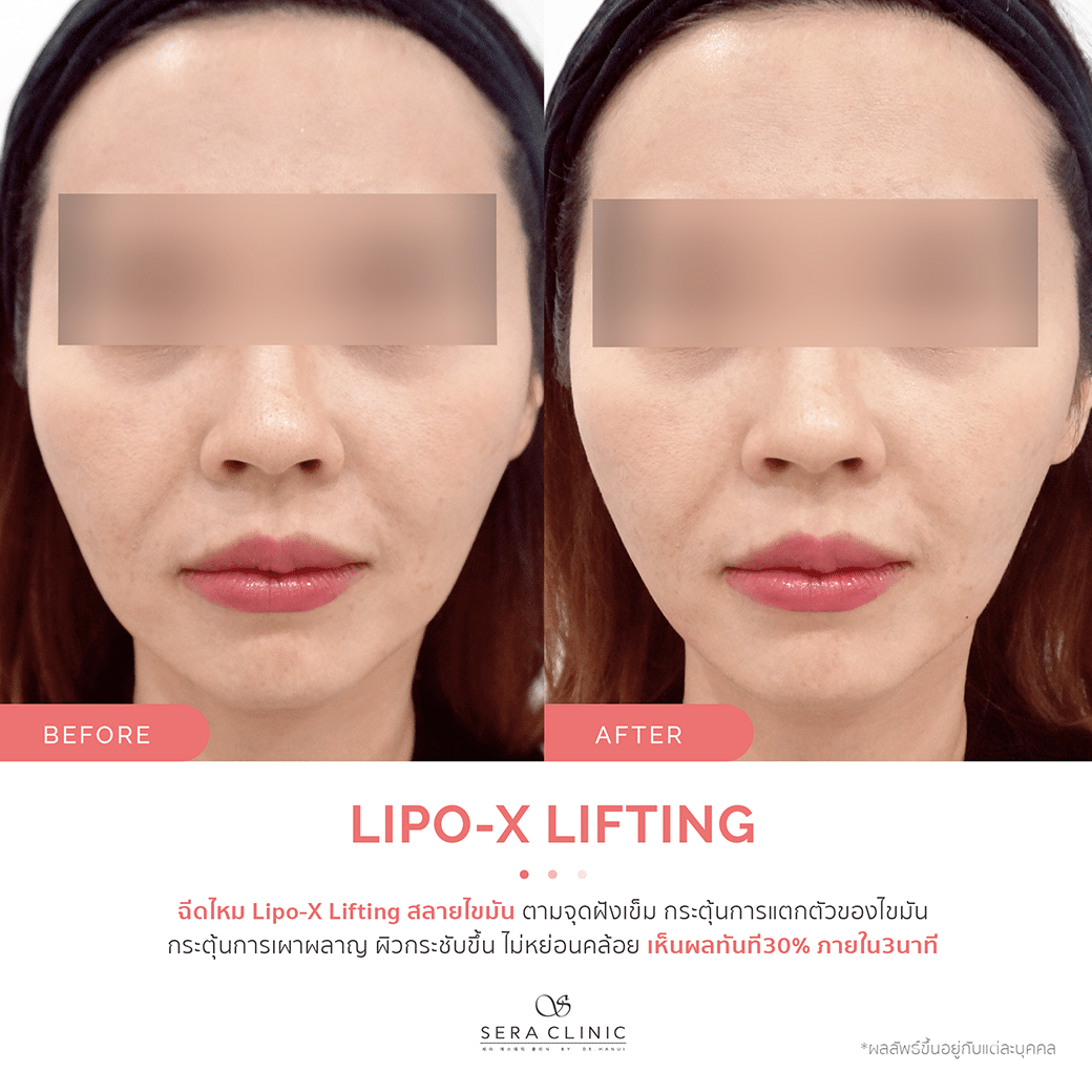 LIPO-X Lifting เหนือกว่าเมโสแฟตที่เคยลอง - Sera Clinic