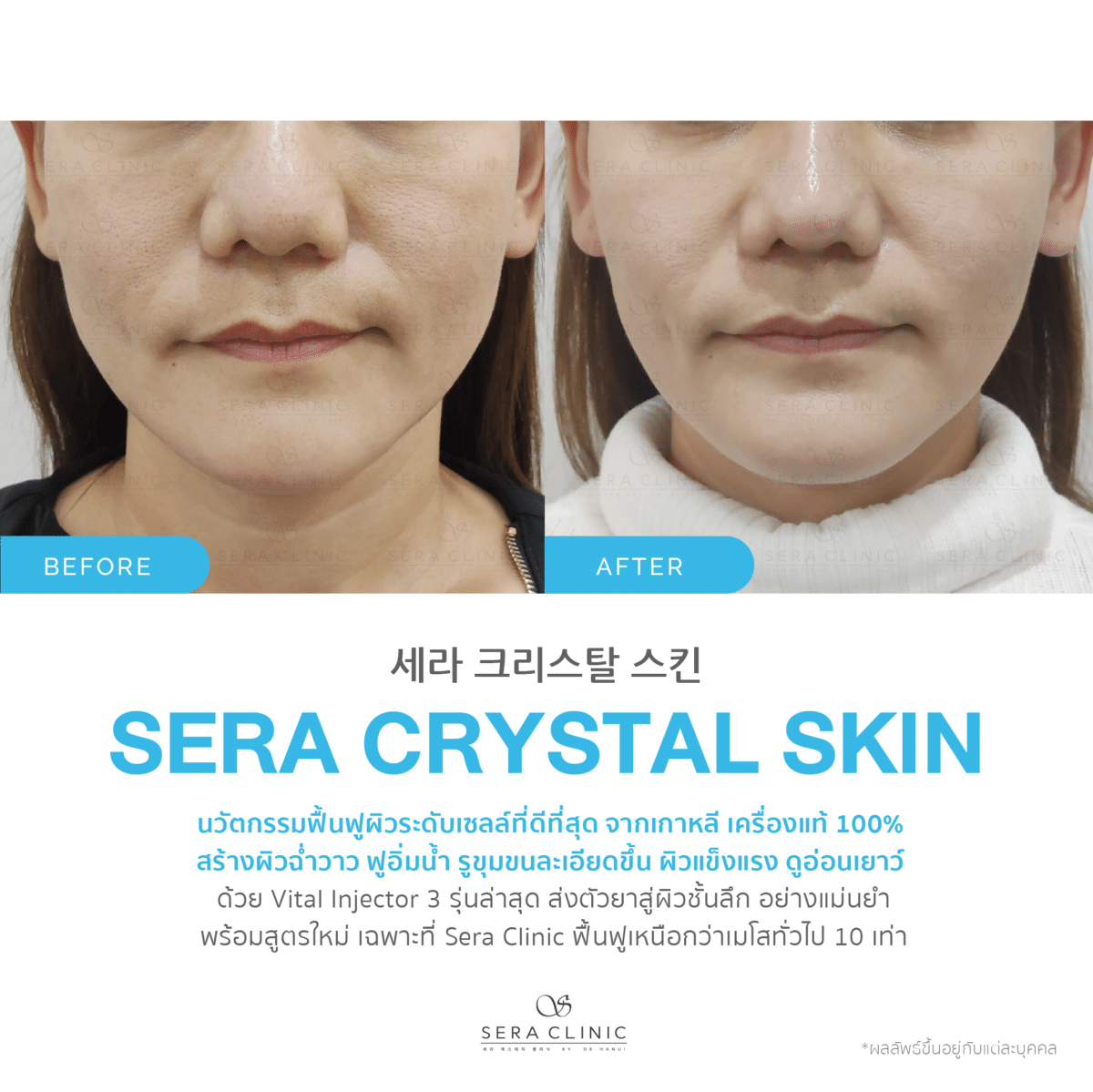 Sera Crystal Skin นวัตกรรมเกาหลีขั้นสูง ฟื้นฟูผิวใส ลึกระดับเซลล์ หน้า ...